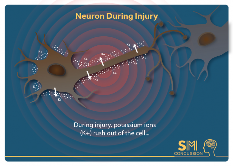 Brain changes during a concussion. Concussion clinic. Belfast. SMNI.
